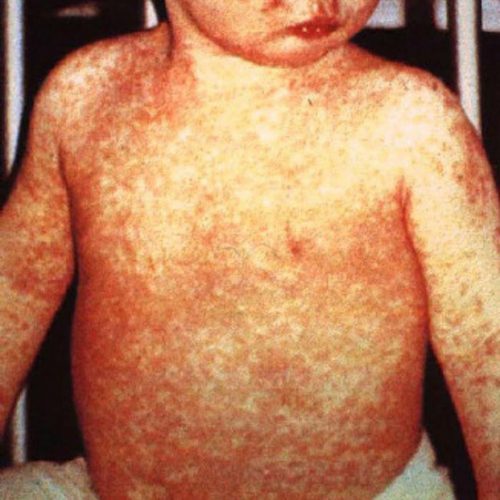 Measles Rash - Encyclopedia of Arkansas